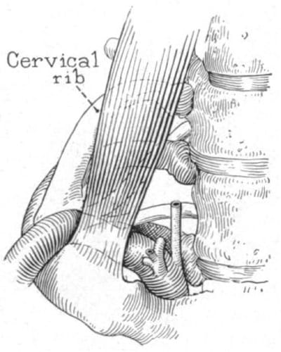 Cervical Rib Diagram 3 Adson Cropped - NeoVista®
