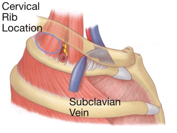 Cervical Rib • Thoracic Outlet Syndrome Testing, Specialists, Symptoms ...
