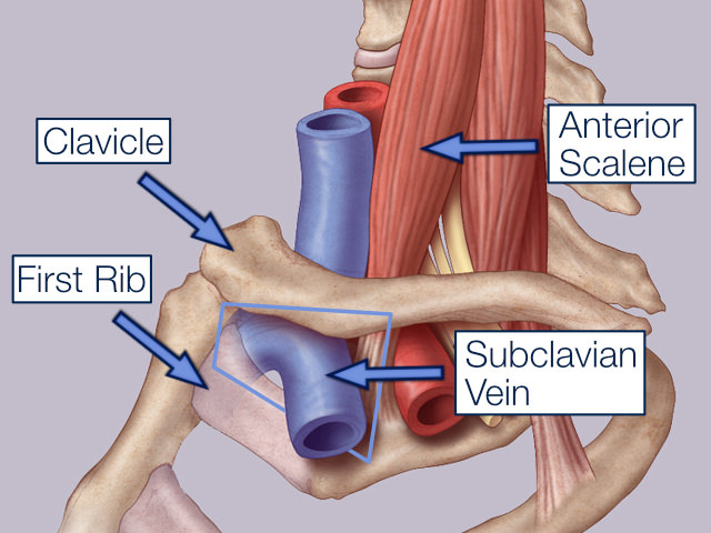 Causes of Venous Thoracic Outlet Syndrome • Thoracic Outlet Syndrome ...
